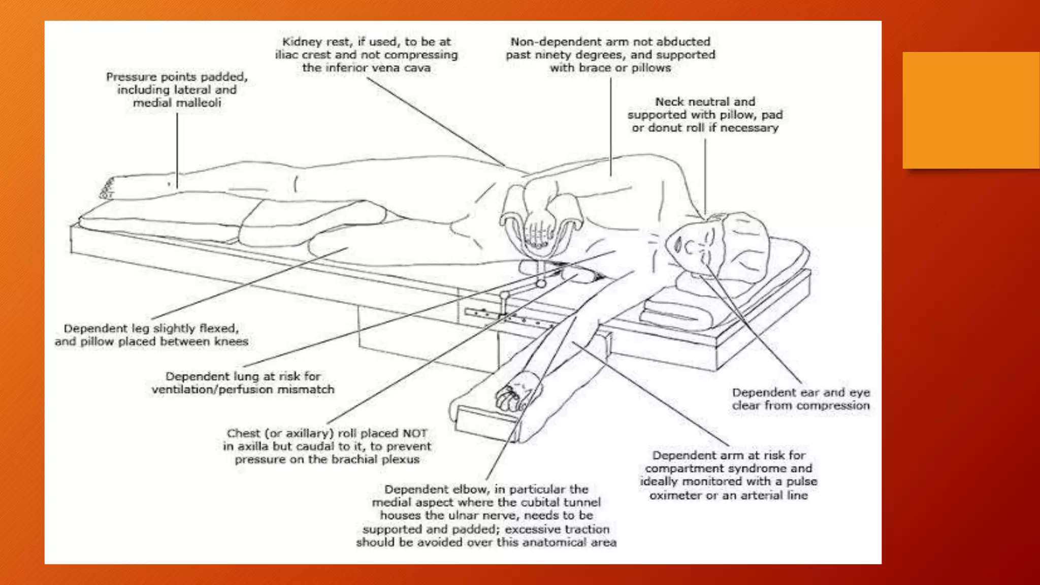 Anterior-o-lateral approach to thoraco lumbar region | PPTX