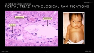 Alagille Syndrome – A Brief Overview | PDF