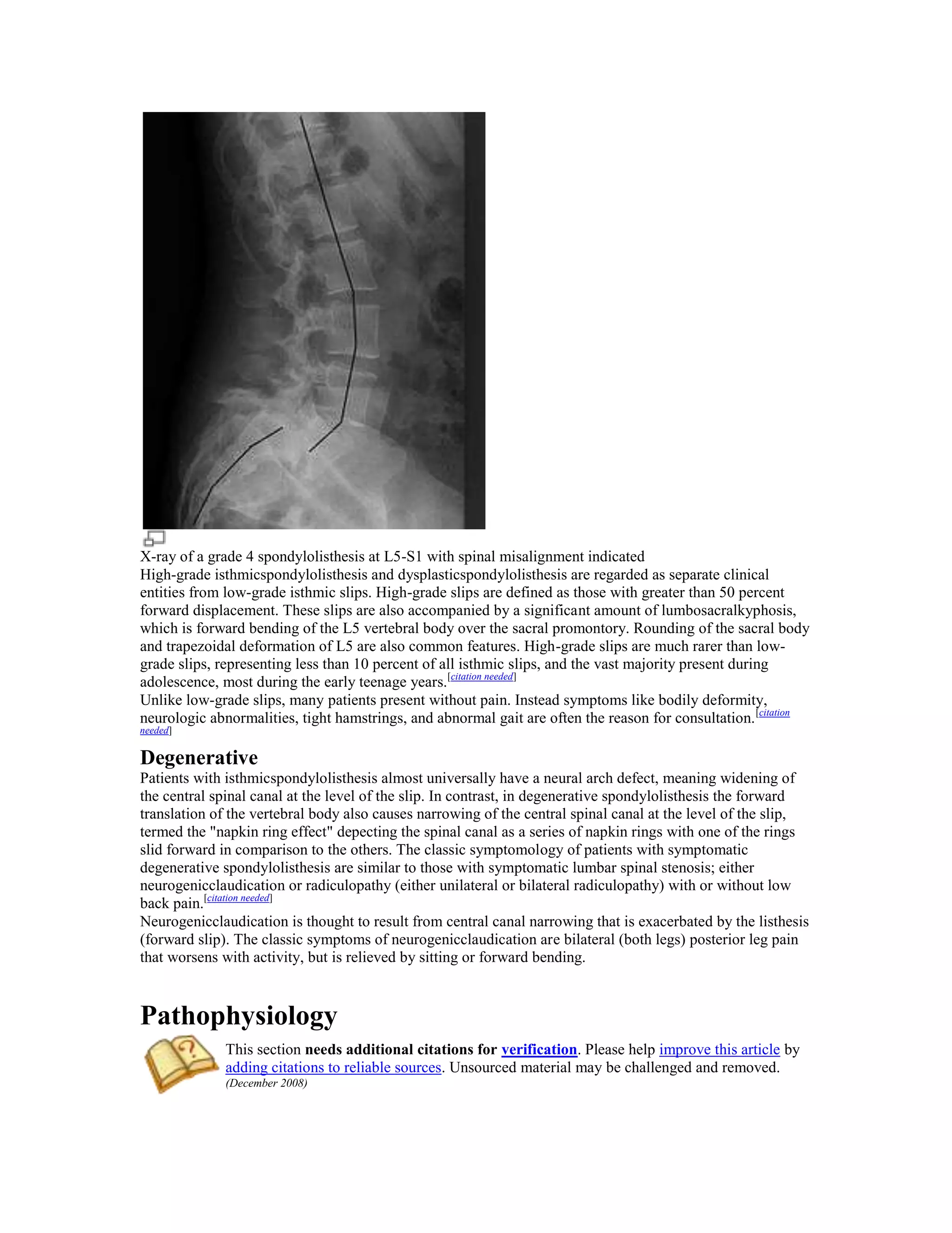 Alan moelleken-md-santa-barbara-spondylolisthesis | DOCX