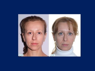 Alar base surgery | PPTX