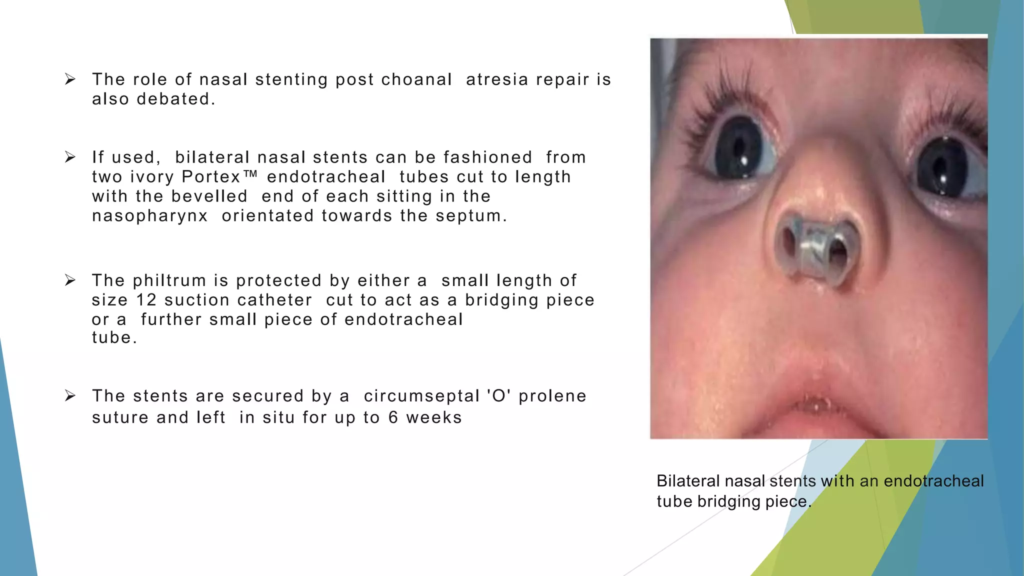 Congenital nasal obstruction | PPTX