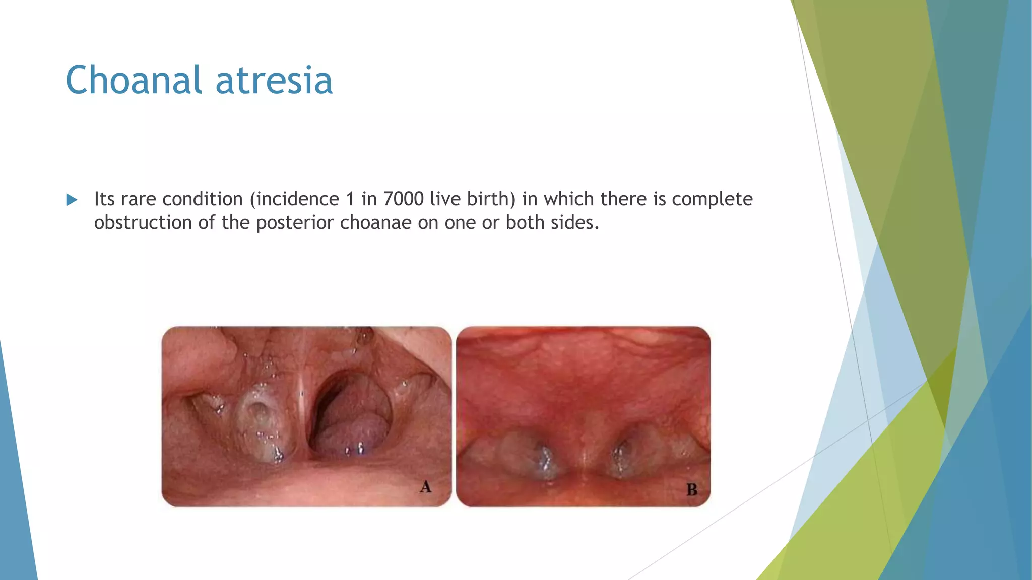 Congenital nasal obstruction | PPTX