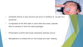 Congenital nasal obstruction | PPTX