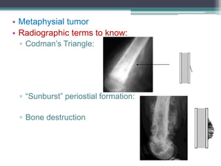 Bone Tumor (Benign and malignant) | PPTX