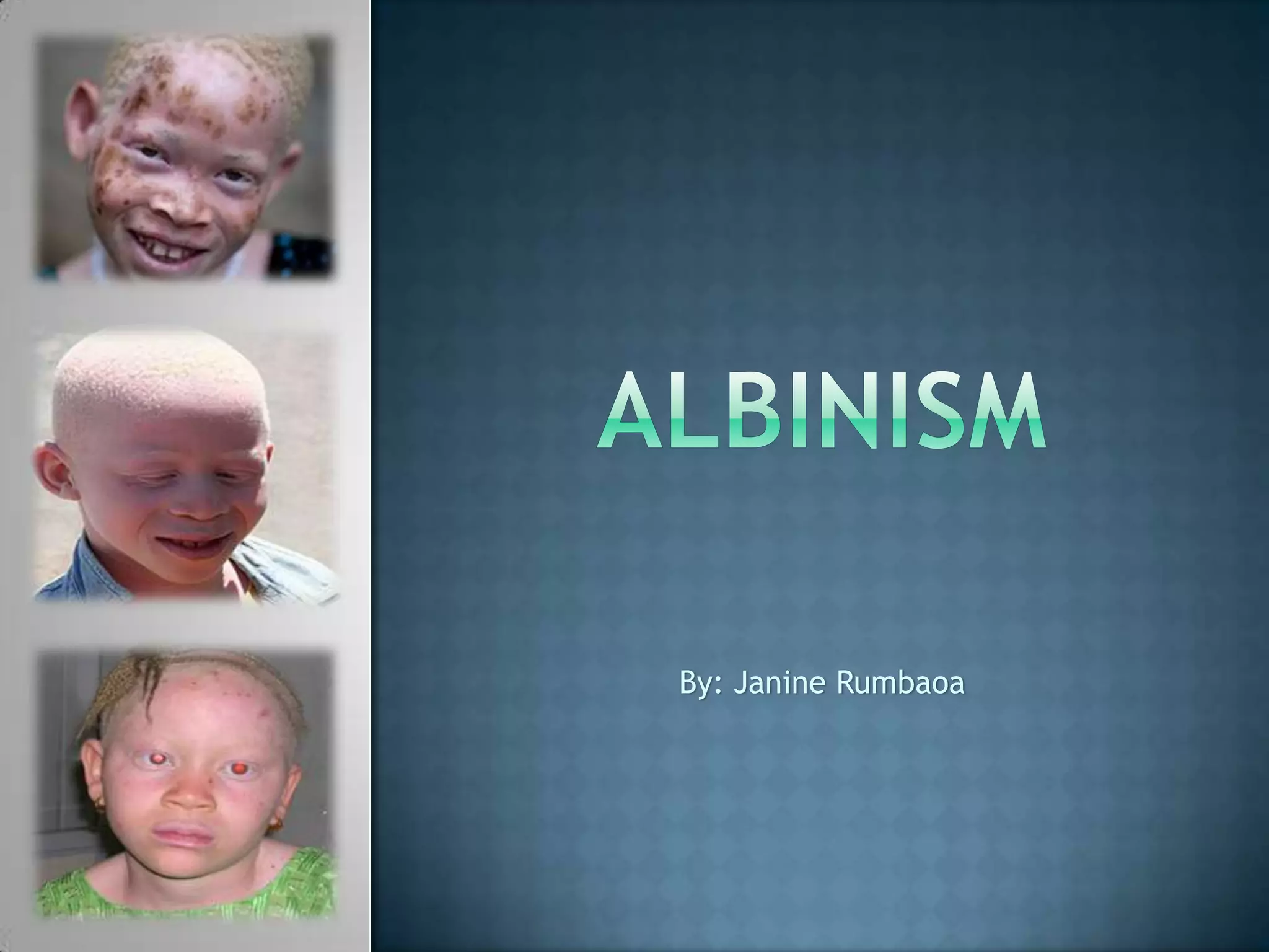 Albinism | PPTX | Eye and Vision Conditions | Diseases and Conditions