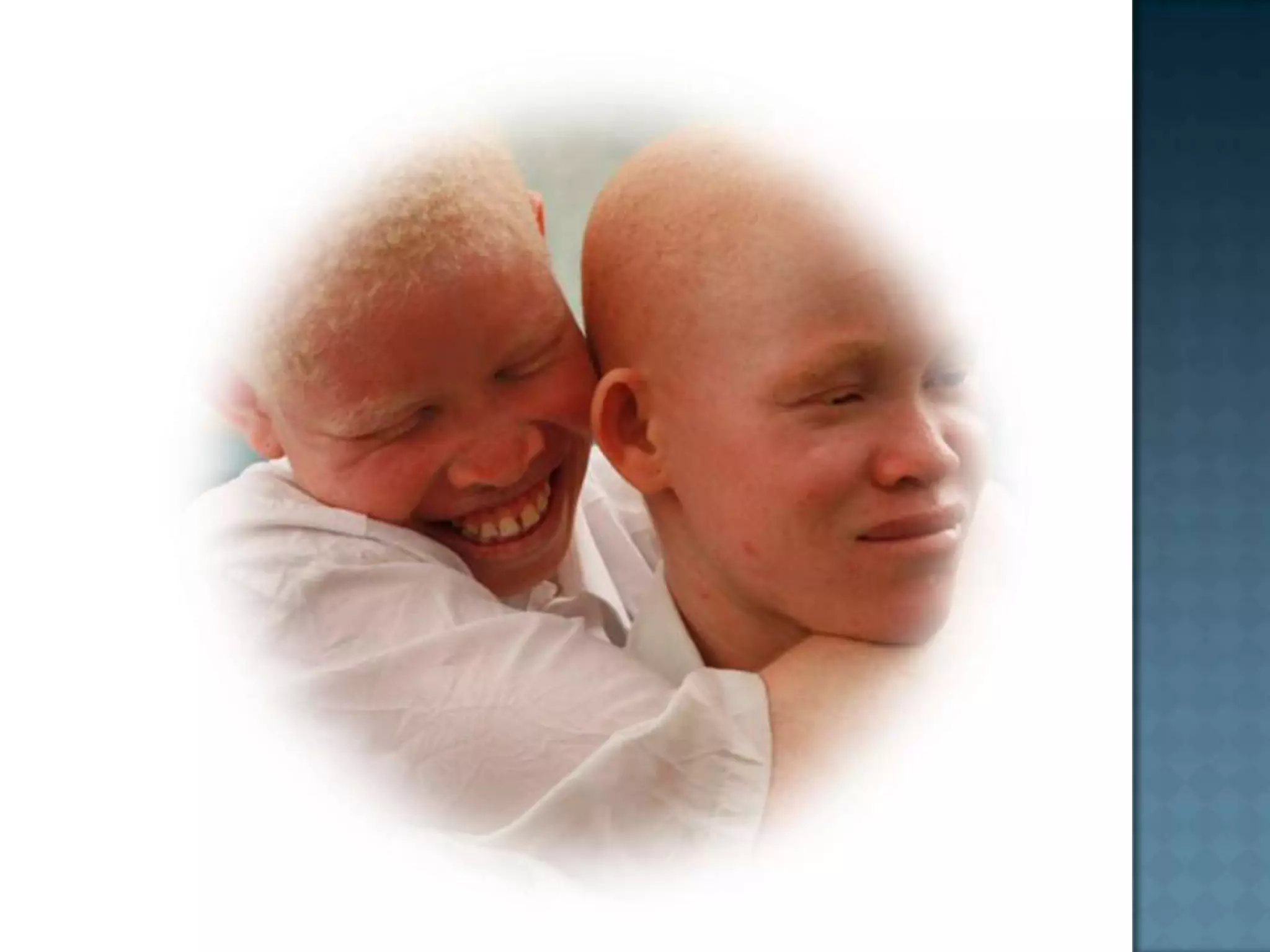 Albinism | PPTX