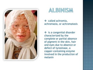 Partial Albinism
