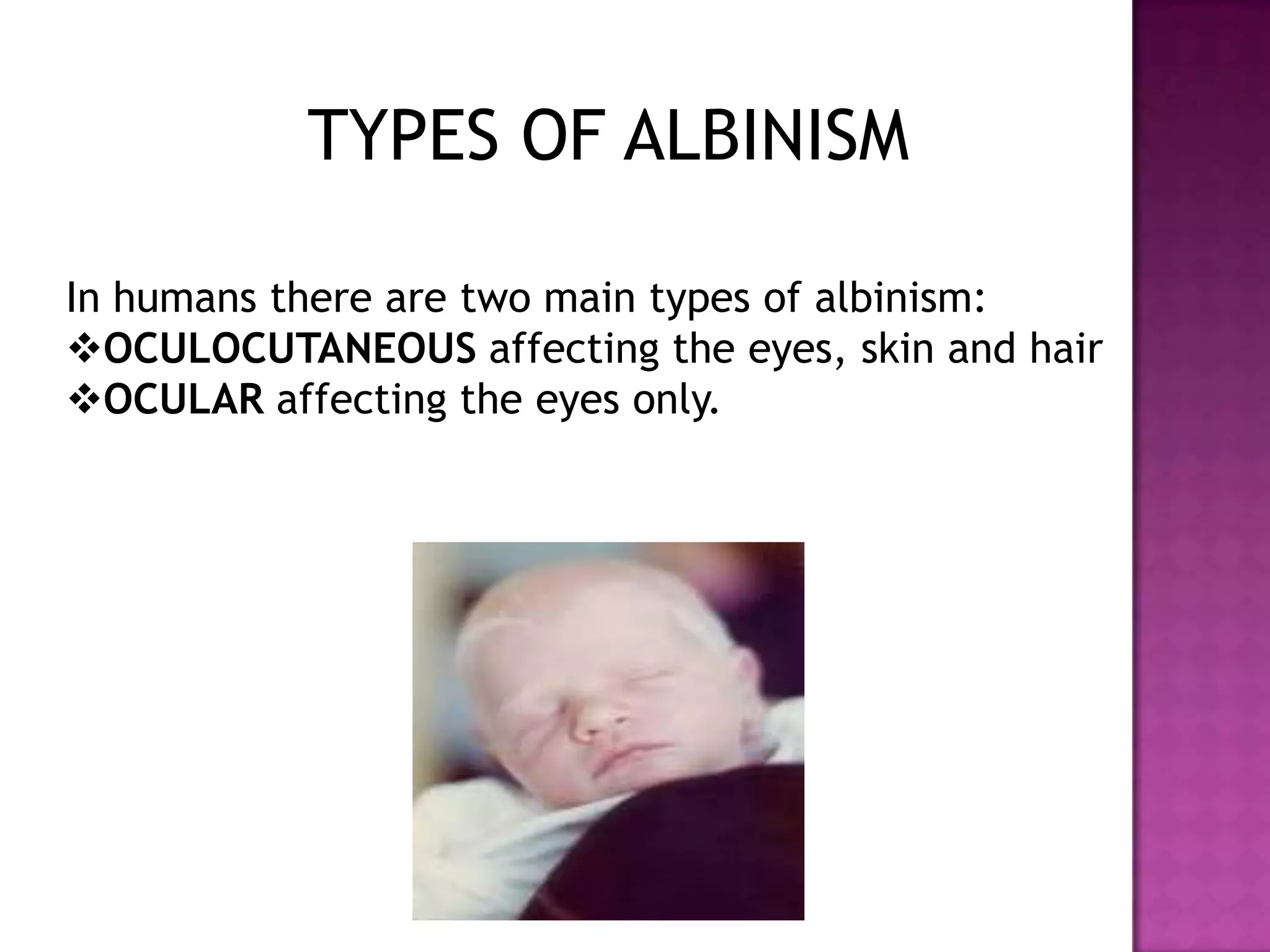 Albinism | PPTX