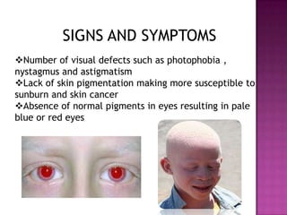Albinism | PPTX