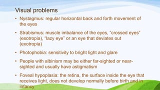 Albinism | PPTX