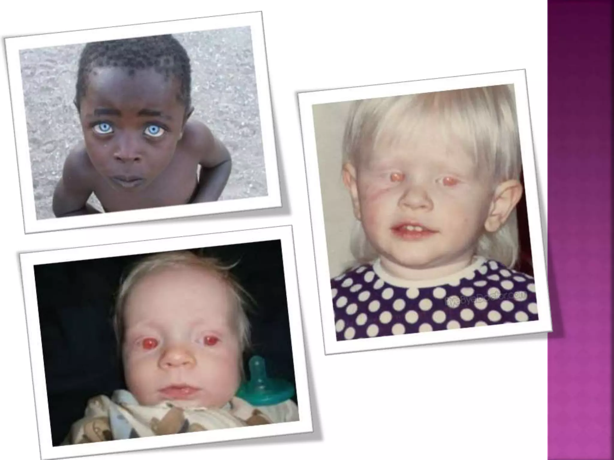 Albinism | PPTX