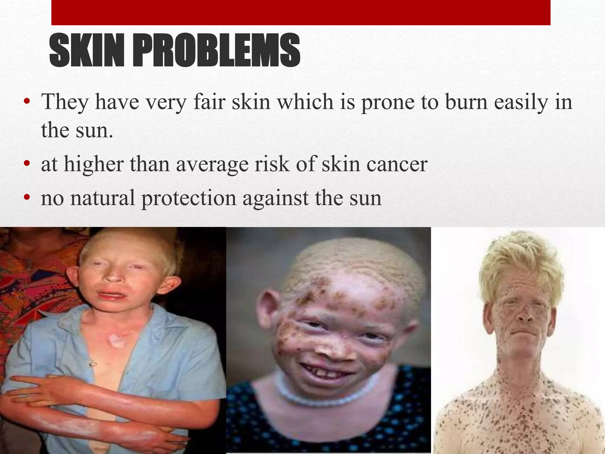 Albinism | PPTX