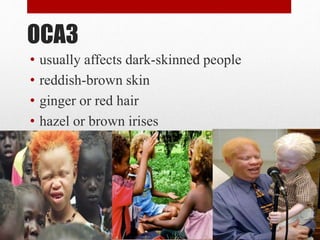 Albinism | PPTX