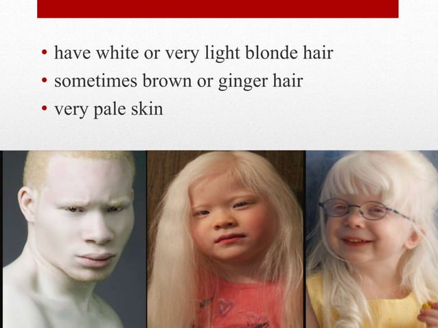 Albinism | PPT
