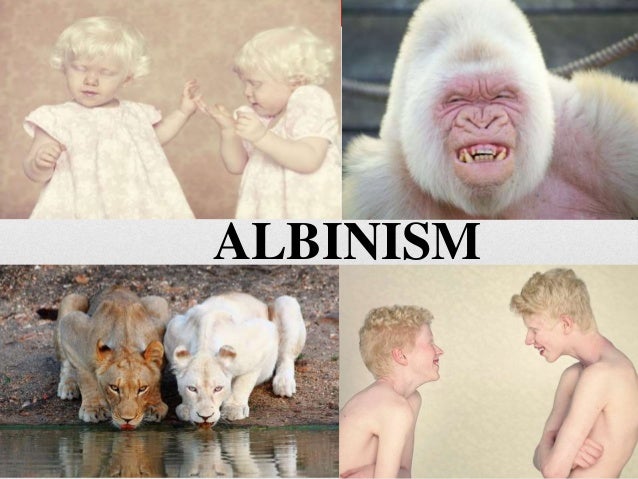 Alles Was Du Ber Albinismus Wissen Musst Demedbook