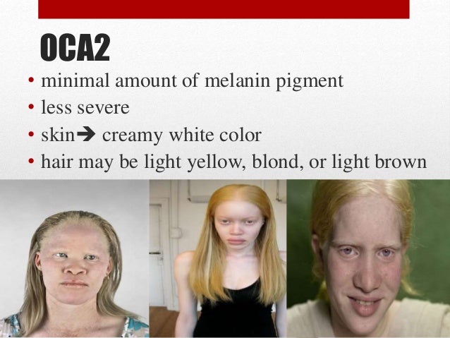 Albinism