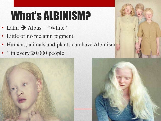 Albinism