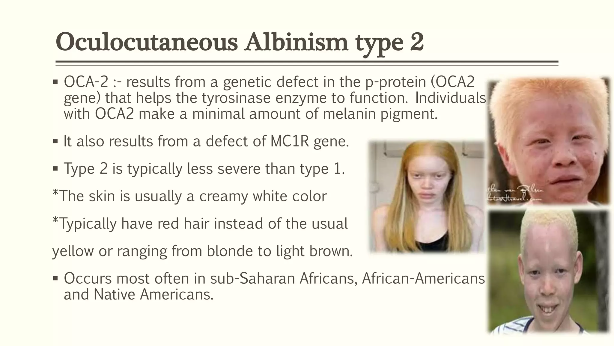 Albinism | PPTX | Eye and Vision Conditions | Diseases and Conditions
