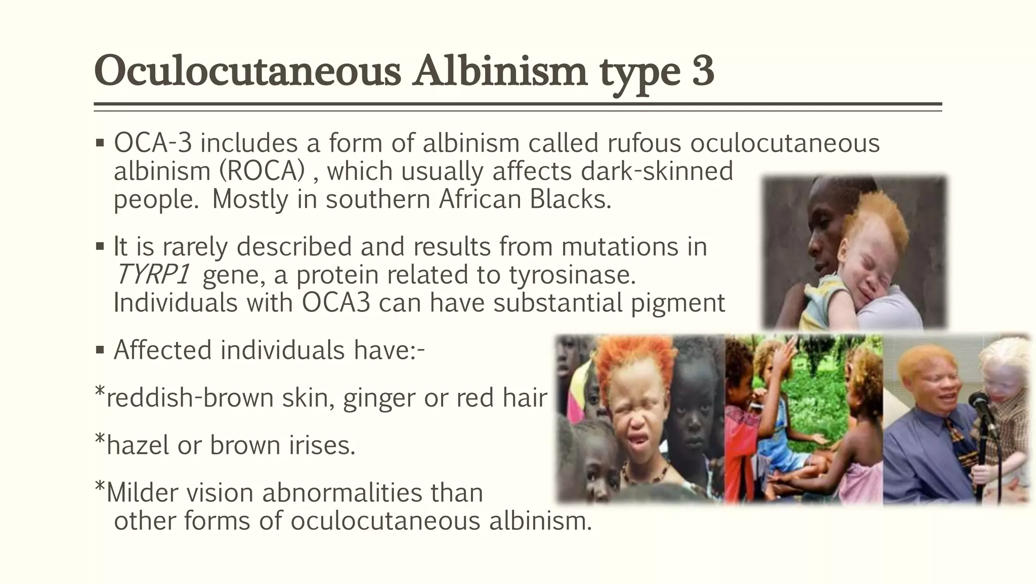Albinism | PPTX | Eye and Vision Conditions | Diseases and Conditions