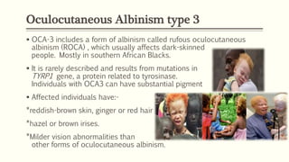 Albinism | PPTX