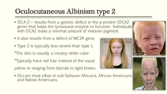Albinism