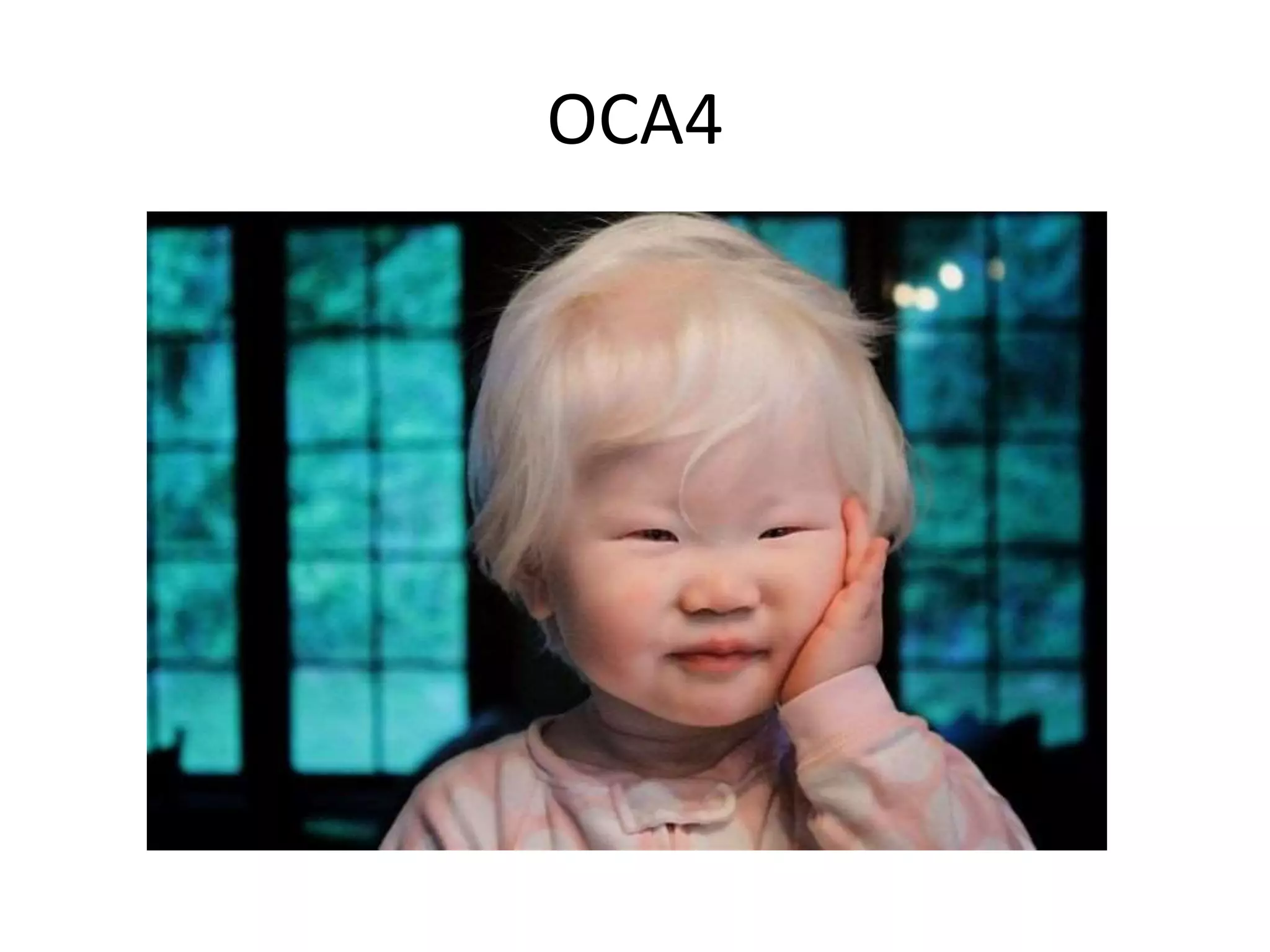 Albinism | PPTX | Eye and Vision Conditions | Diseases and Conditions