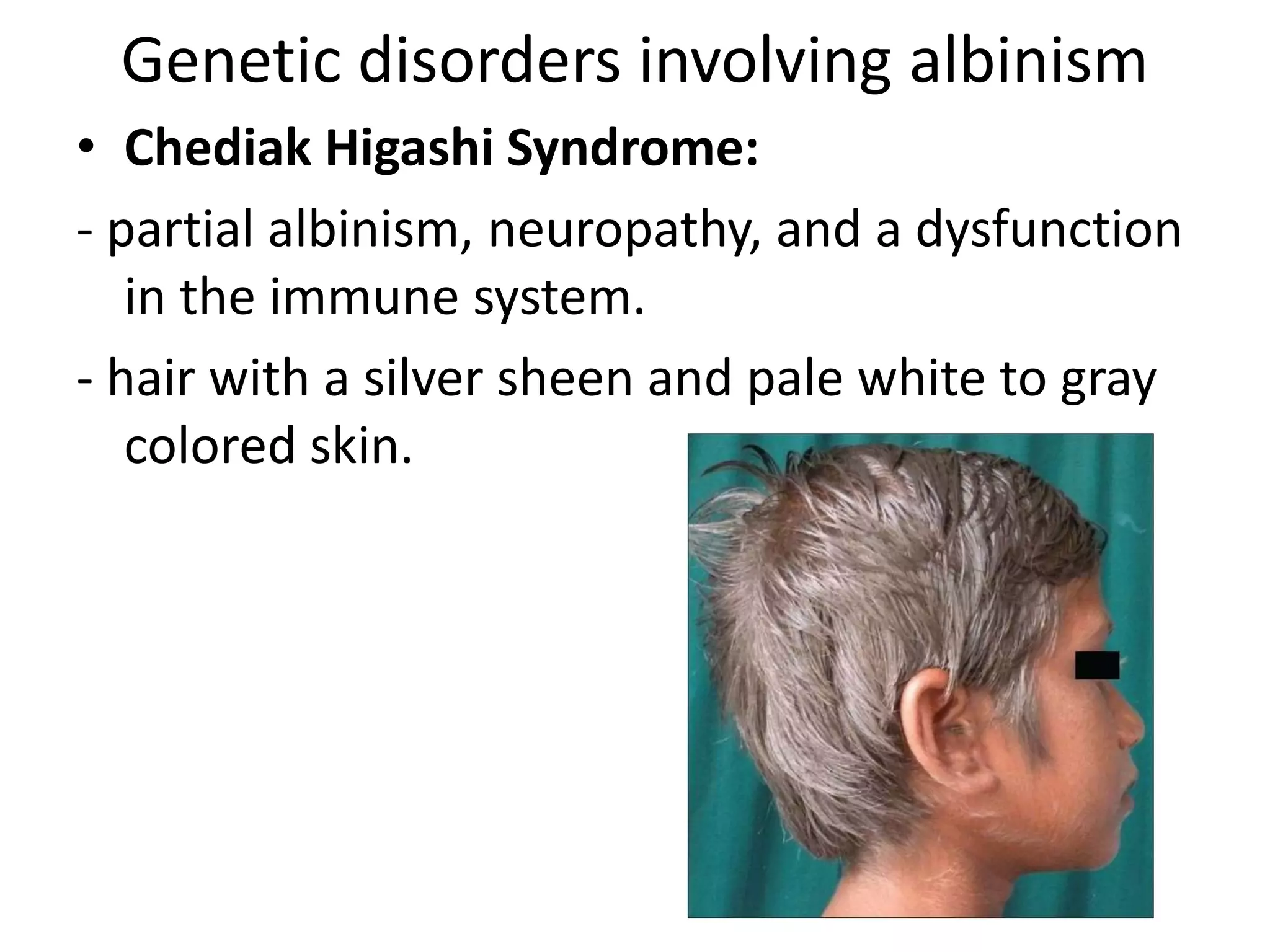 Albinism | PPTX | Eye and Vision Conditions | Diseases and Conditions