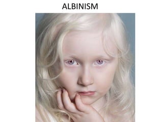 Albinism | PPTX | Eye and Vision Conditions | Diseases and Conditions