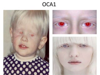 Albinism | PPTX | Eye and Vision Conditions | Diseases and Conditions