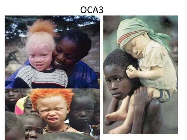 Albinism | PPTX | Eye and Vision Conditions | Diseases and Conditions