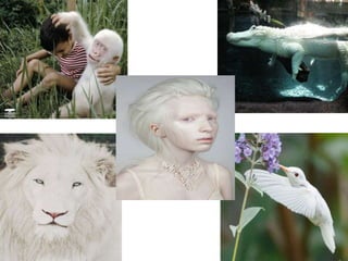 Albinism | PPTX | Eye and Vision Conditions | Diseases and Conditions