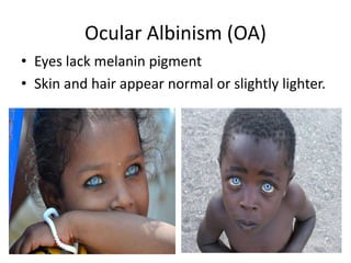 Partial Albinism
