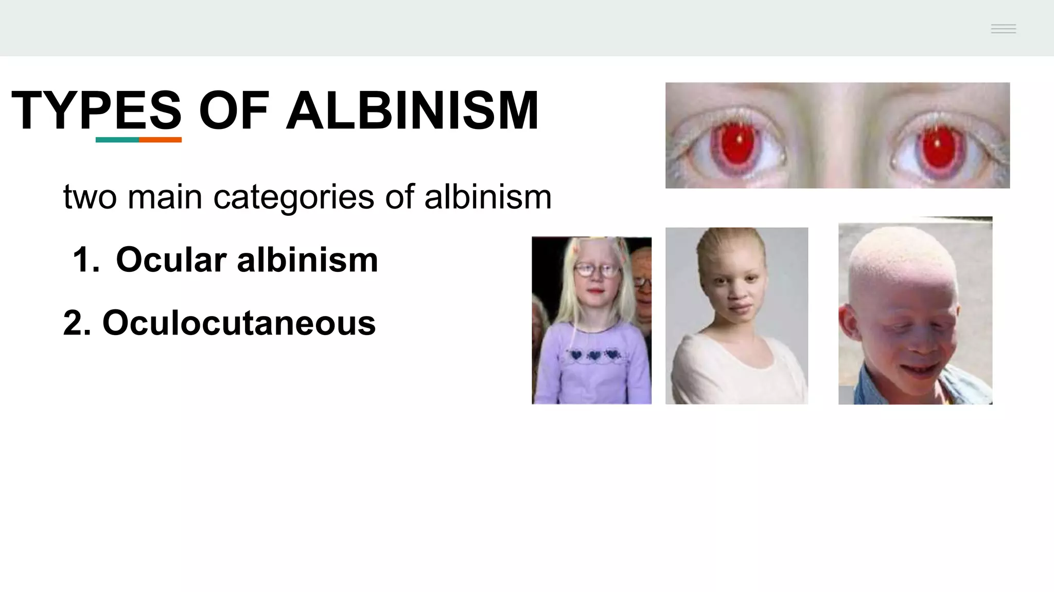 Albinism | PPTX