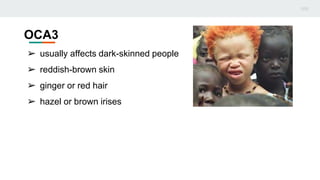 Albinism | PPTX