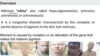 Albinism | PPTX
