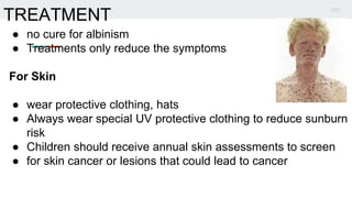 Albinism | PPTX