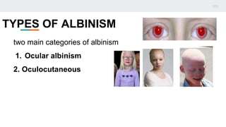 Oculocutaneous Albinism Type 4