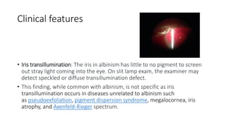 Albinism.pptx
