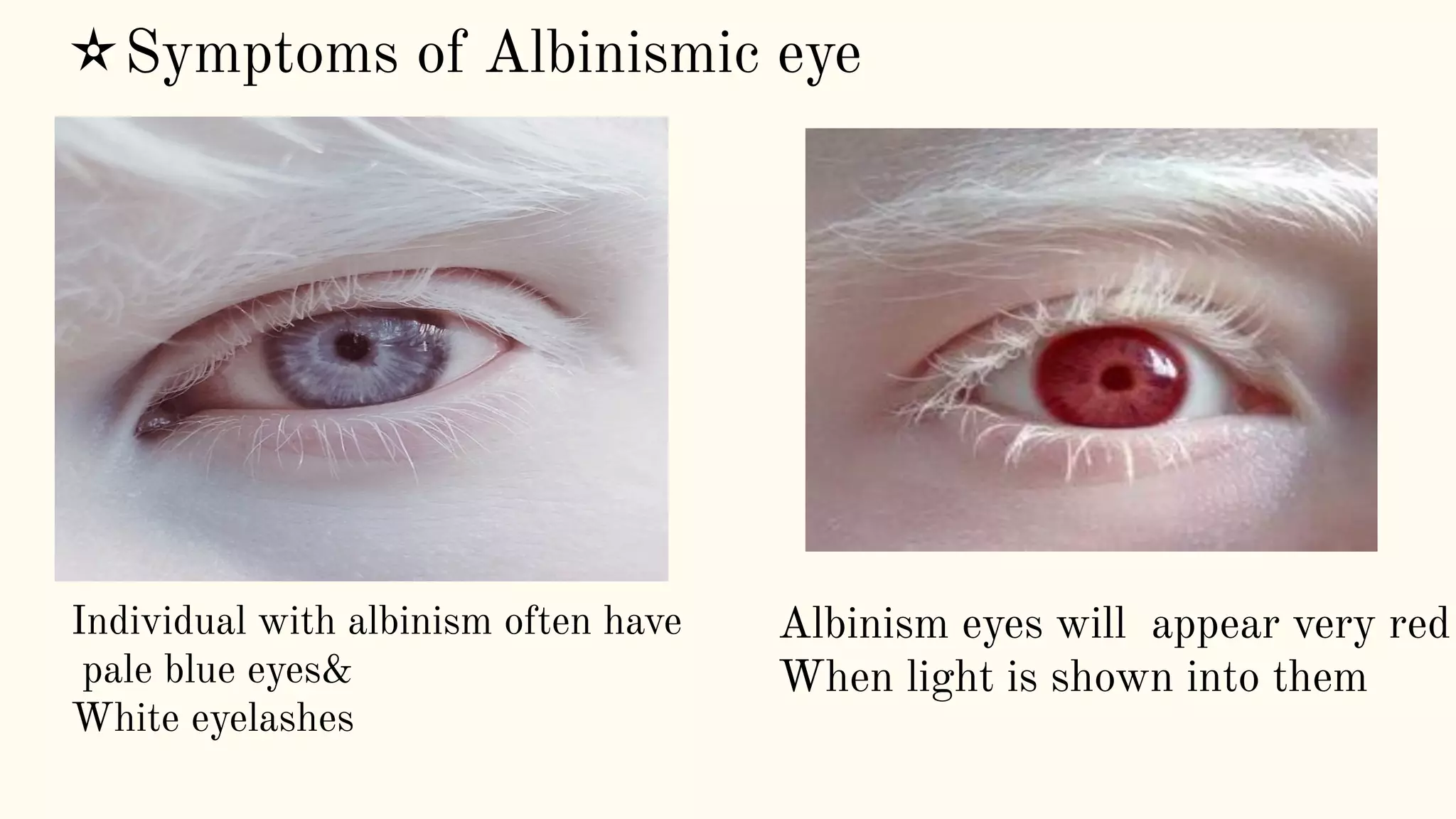 Albinism.pdf