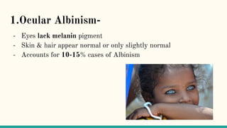 Albinism.pdf