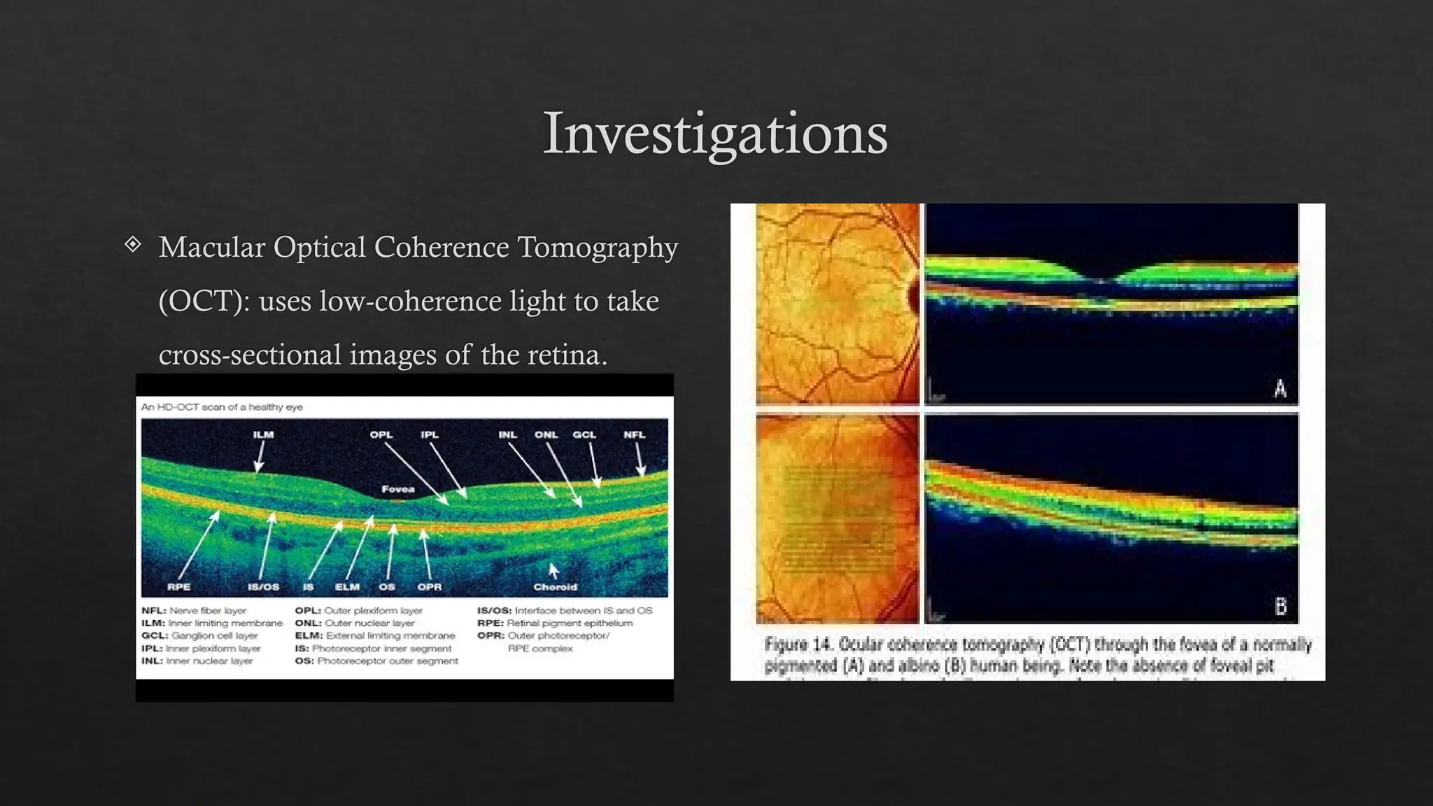 Variants and Management of Albinism.pptx