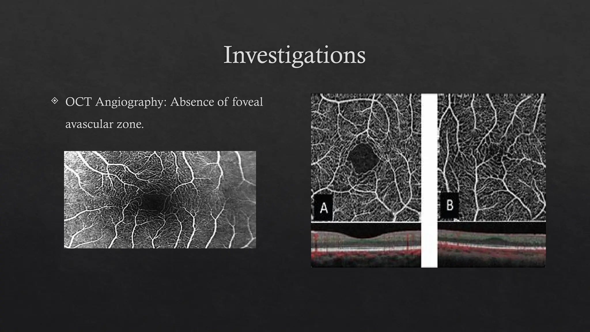 Variants and Management of Albinism.pptx