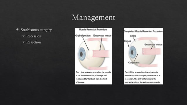 Variants and Management of Albinism.pptx