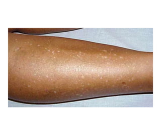 Hypopigmentation Disorders | PPT