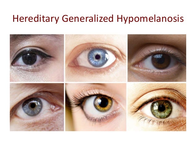 Hypopigmentation Disorders