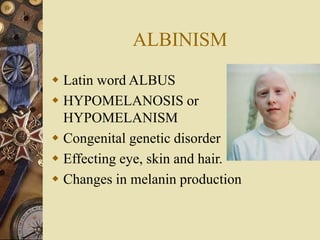 oculocutaneous albinism | PPT