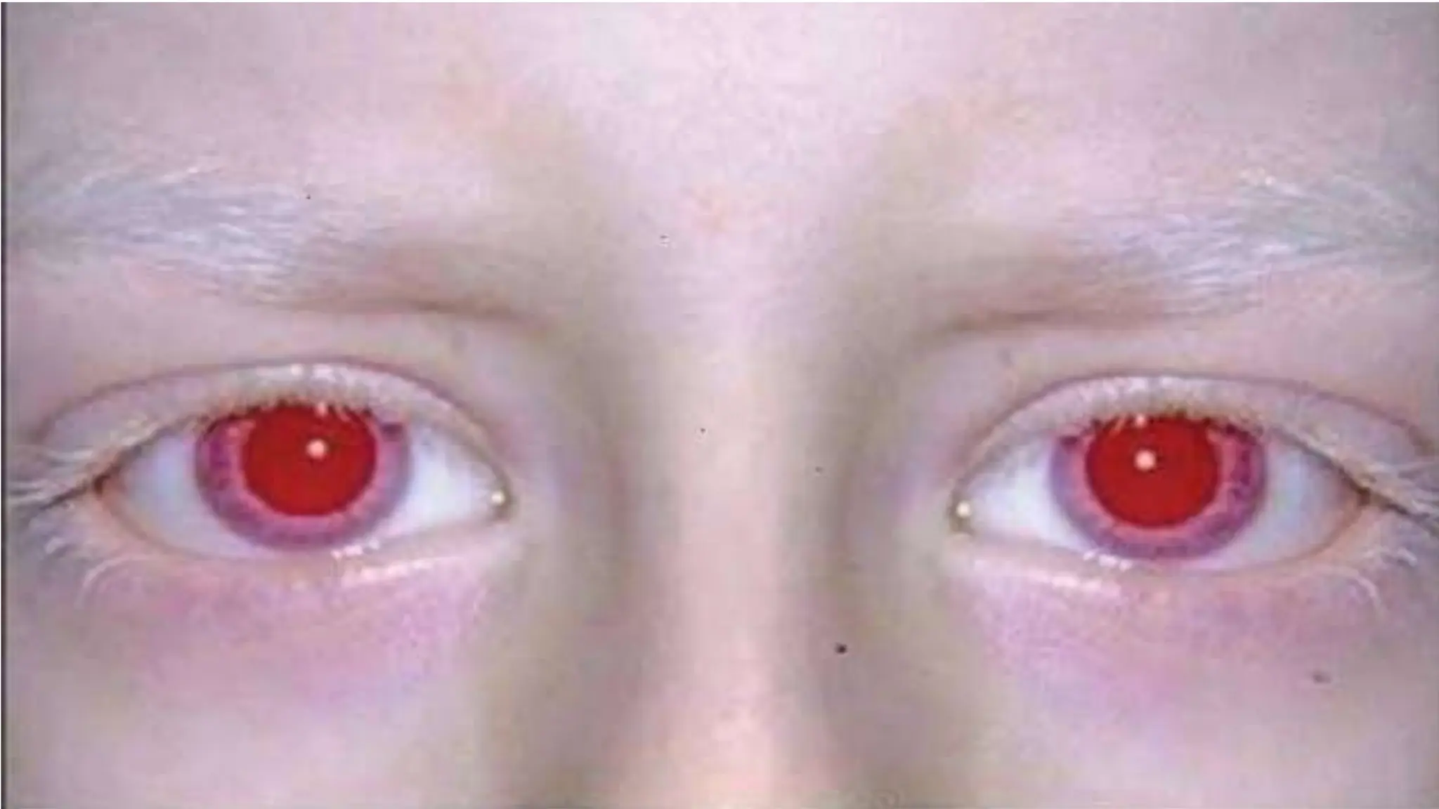 ALBINISM , definition, Inheritance, Biochemical Basis,Types ...