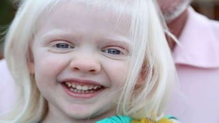 ALBINISM , definition, Inheritance, Biochemical Basis,Types ...