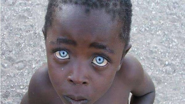 ALBINISM , definition, Inheritance, Biochemical Basis,Types ...