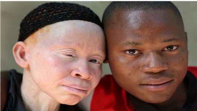 ALBINISM , definition, Inheritance, Biochemical Basis,Types ...